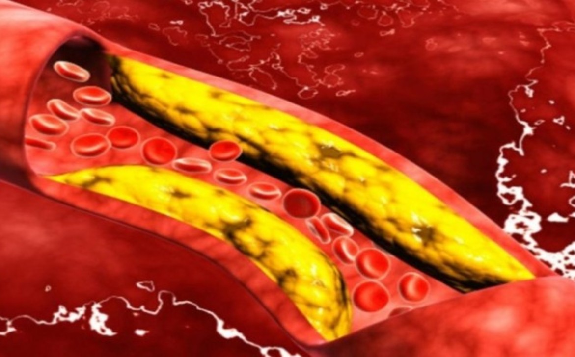 Cara Membaca Profil Lemak Hasil Lab Medis dan Maksudnya – Kissparry